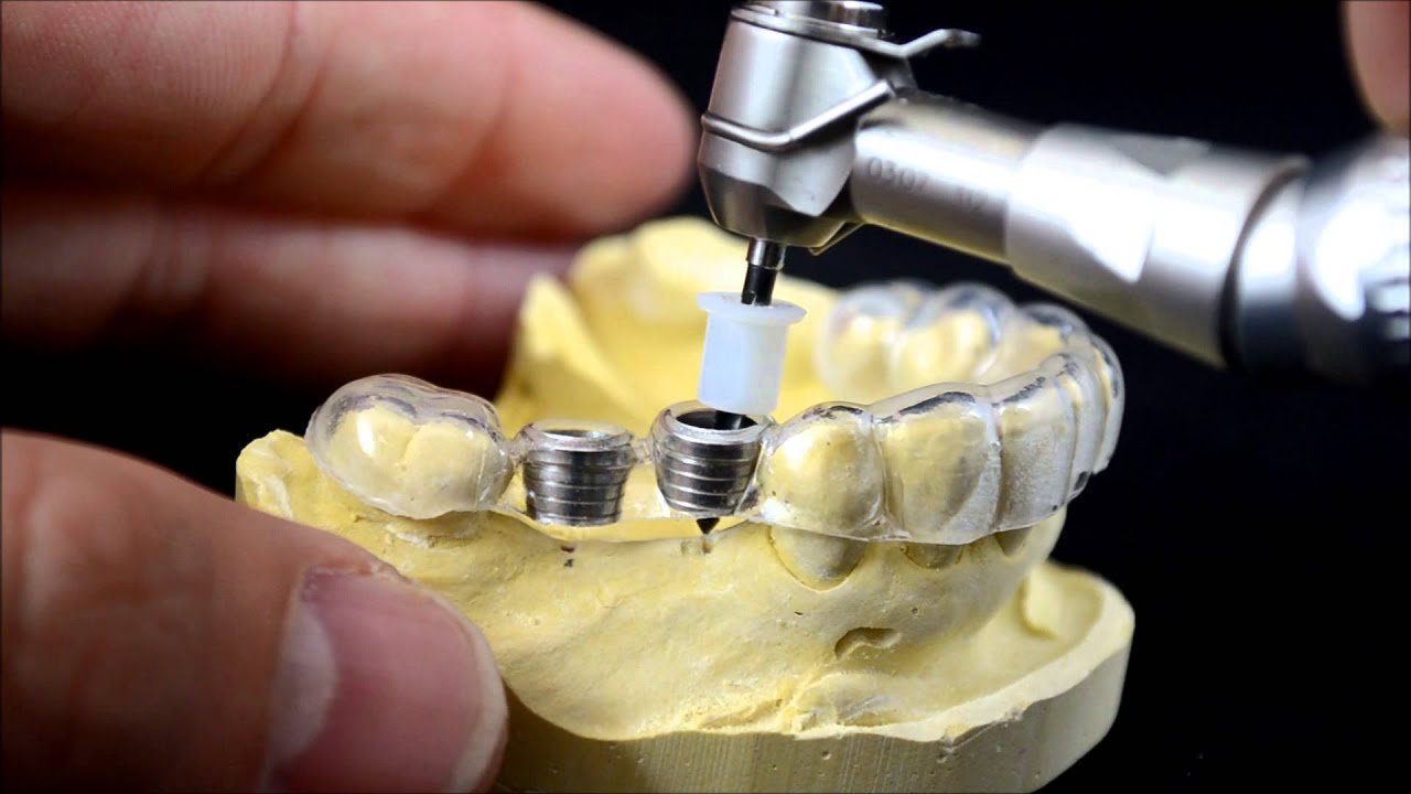 Secret of Accurate and Efficient Dental Implants: Master the Blue Sky ...